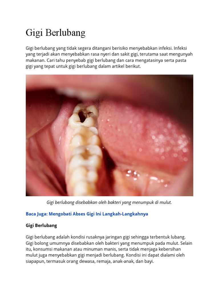 Gigi Berlubang: Gigi Berlubang Disebabkan Oleh Bakteri Yang Menumpuk Di ...