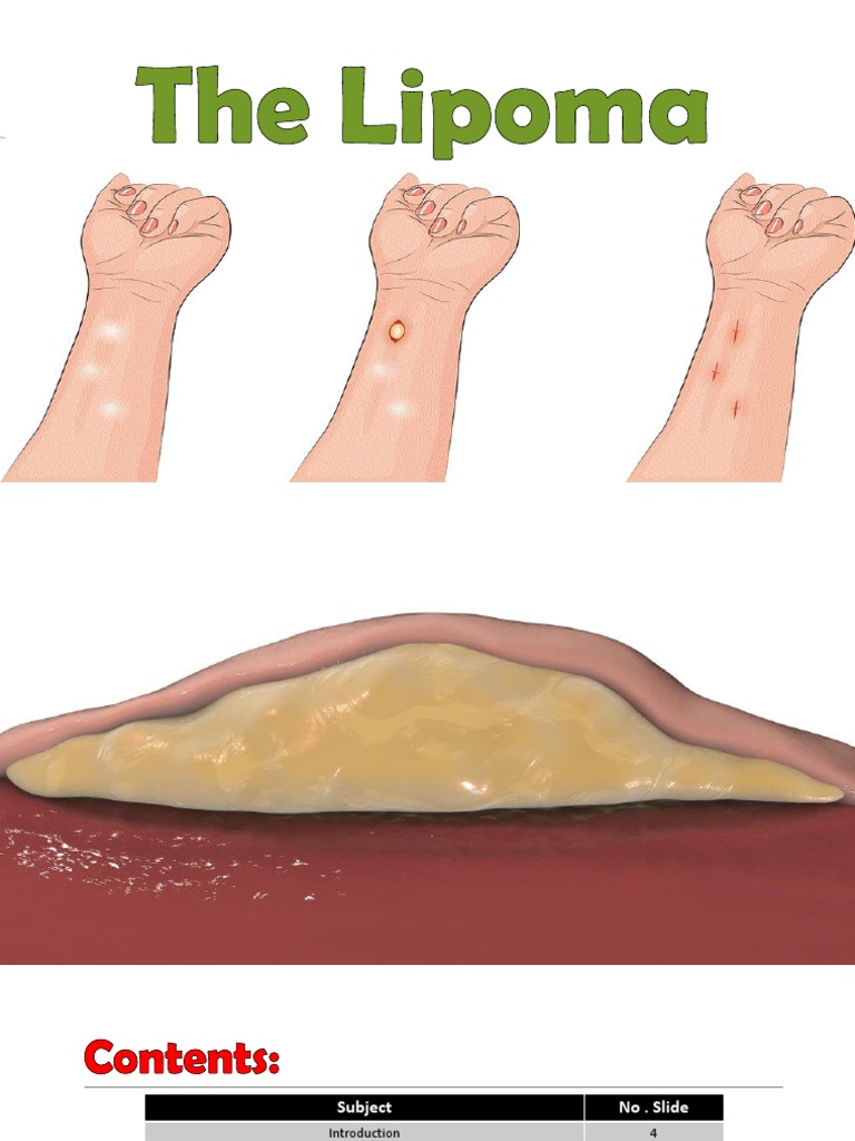 The Lipoma | PDF | Cancer | Epidemiology