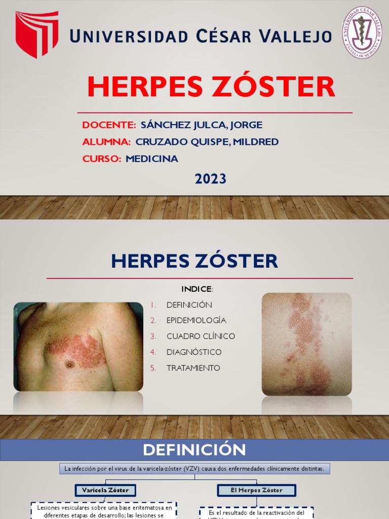 HERPES ZOSTER | PDF