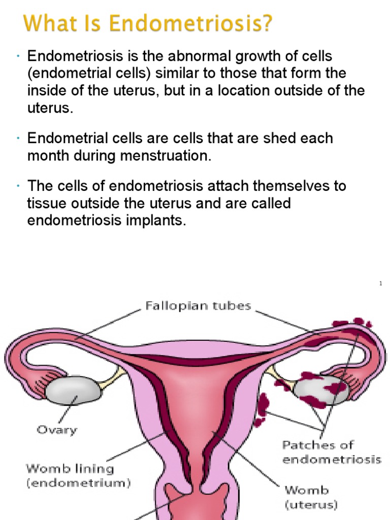 Lect 32 Unit IV Endometriosis | PDF | Uterus | Sexual Anatomy
