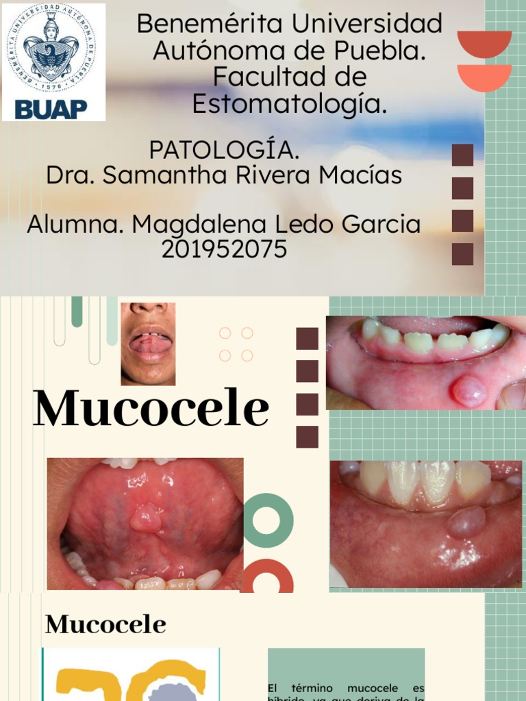 Mucocele | PDF | Enfermedades y trastornos | Medicina CLINICA