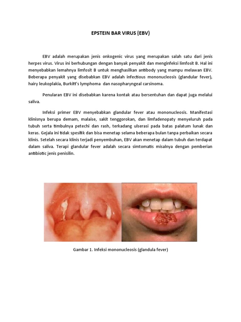 Epstein Bar Virus | PDF