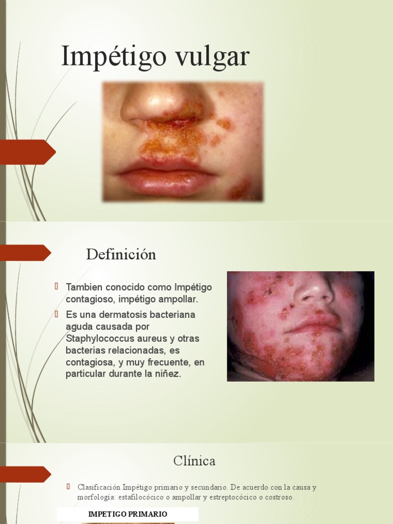 IMPETIGO | PDF | Relaciones personales, crianza y desarrollo personal ...