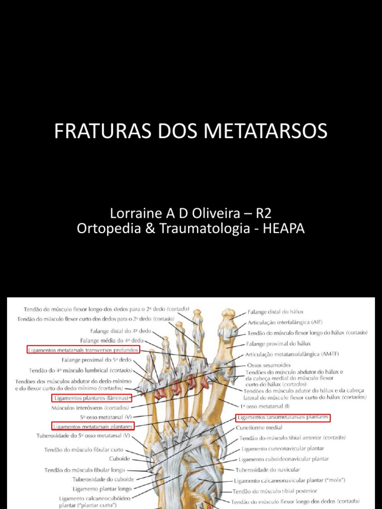Principais tipos de fraturas dos metatarsos e suas abordagens ...