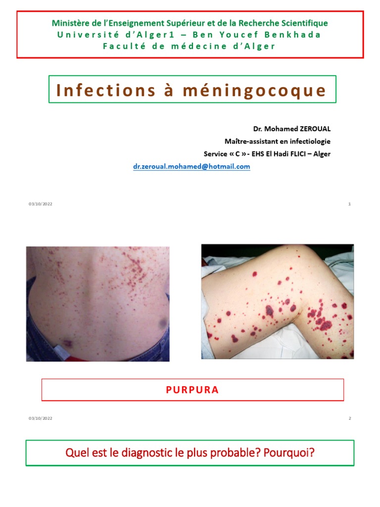 Infection À Méningocoque | PDF