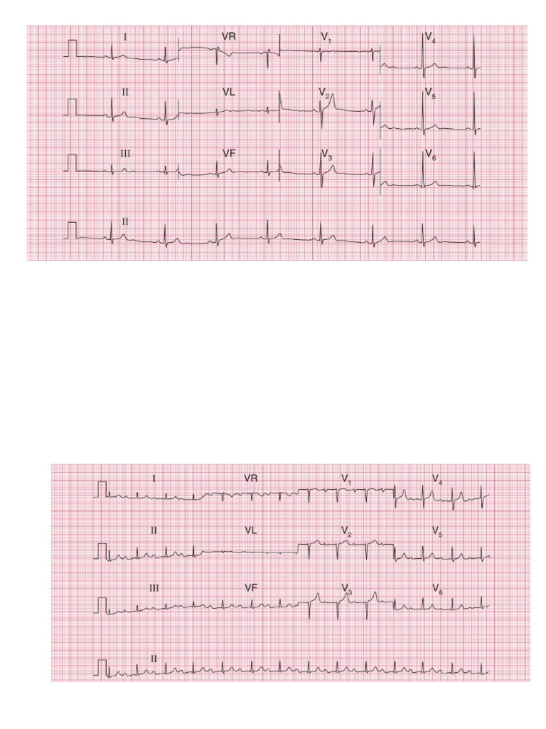 Ejercicio Interpretación Ekg | PDF
