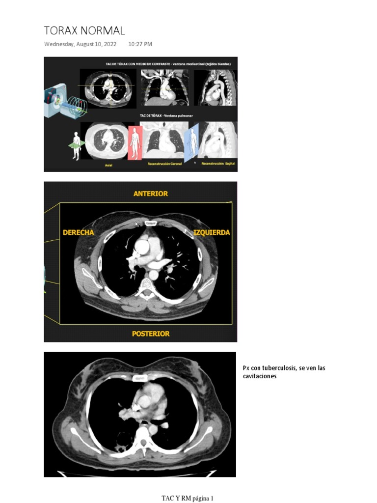 Tac y RM | PDF | Pulmón | Riñón