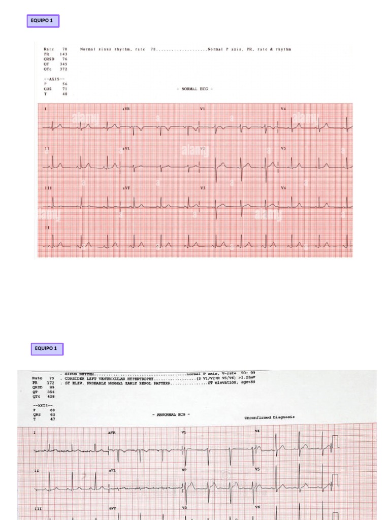 Ejercicios Con ECG | PDF