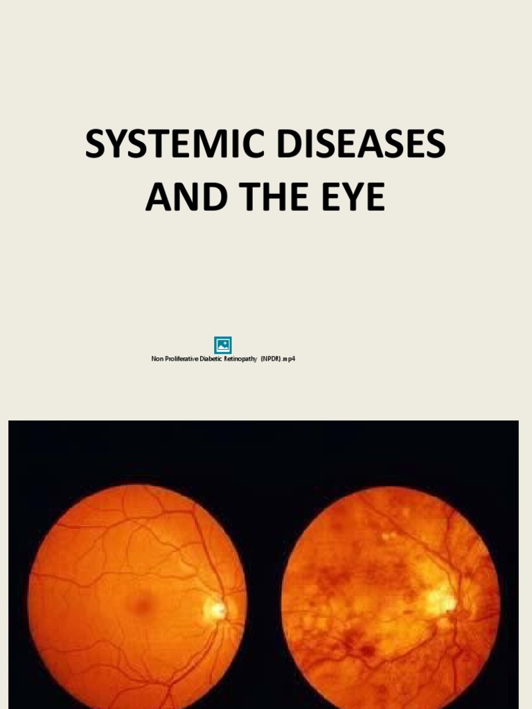 Systemic Disease and Eye | PDF