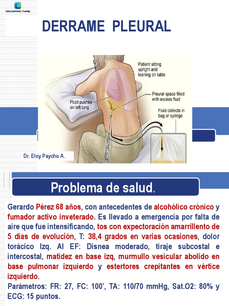 Derrame Pleural. | PDF | Causas de la muerte | Medicina CLINICA
