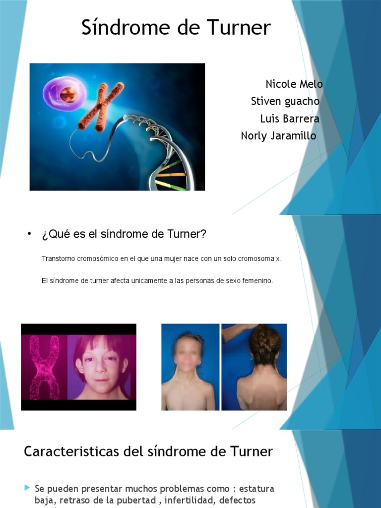 Síndrome De Turner Pdf 