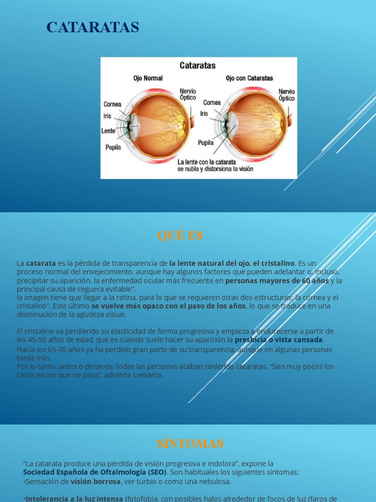 Síntomas y Tratamiento de Cataratas | PDF | Catarata | Ojo humano