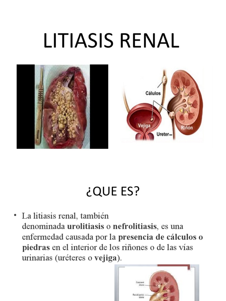 Litiasis Renal | PDF