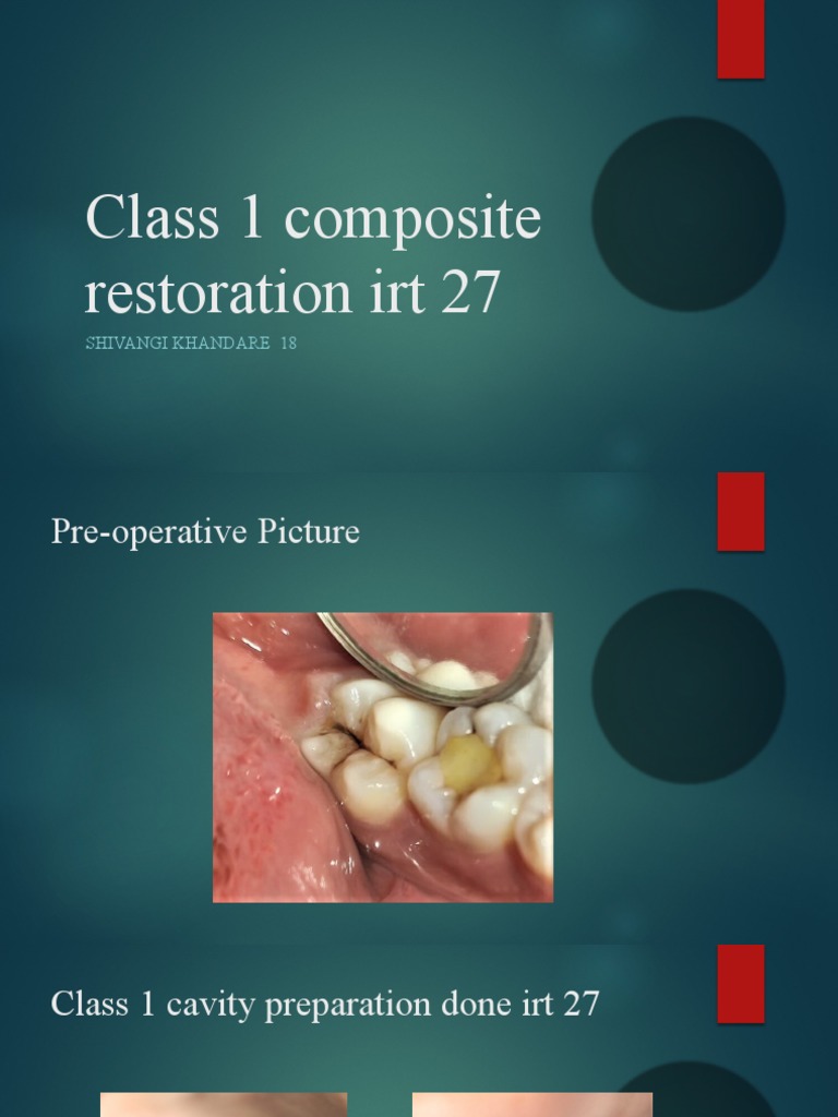 Class 1 Composite Restoration Irt 27 | PDF