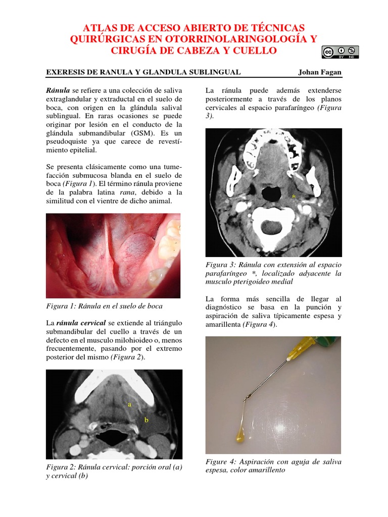 Exéresis de Ránula Sublingual y Cervical | PDF | Anatomía | Anatomia animal