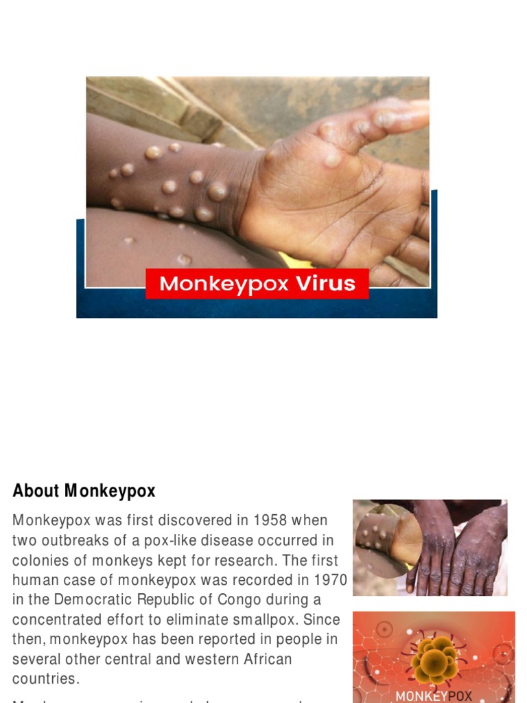 Monkeypox Symptoms, Transmission & Prevention | PDF
