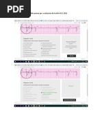Tipos de Ritmos Cardíacos y Bloqueos AV | PDF