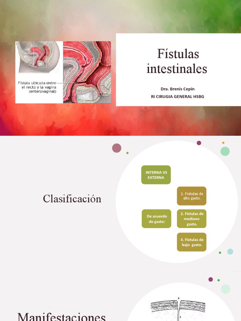 Fistulas Intestinales | PDF