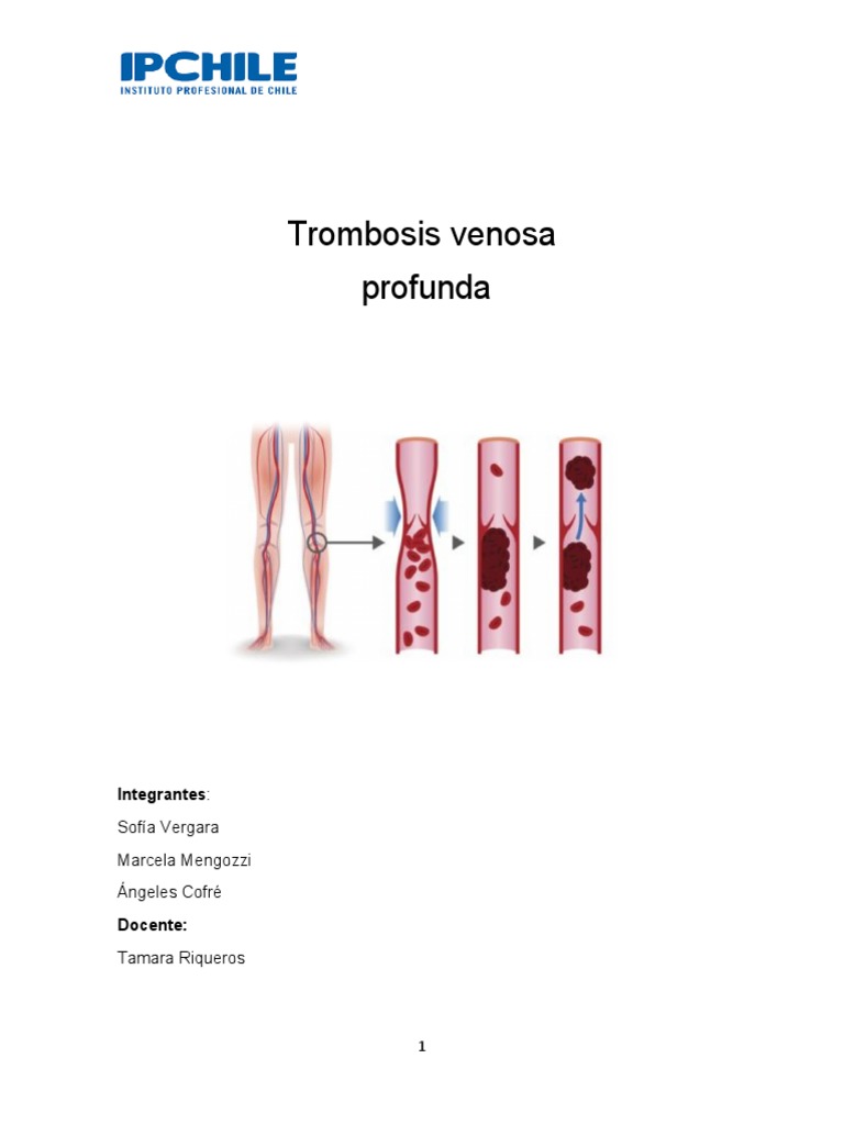 Qué es la trombosis venosa profunda2 | PDF | Trombo | Embolia