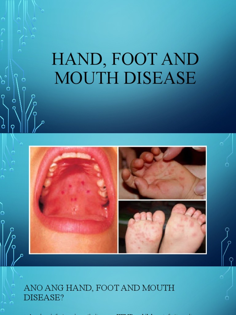 Hand Foot and Mouth Disease | PDF