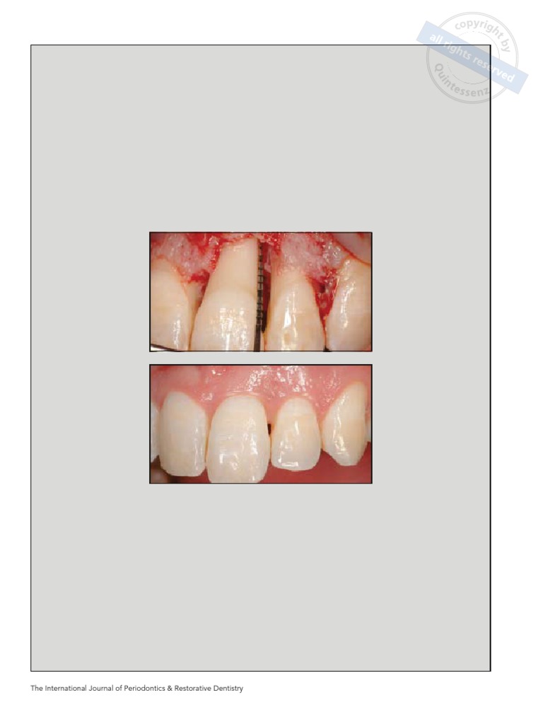 Artículo de Técnica Del Muro. G. Zucchelli | PDF | Periodontology | Mouth