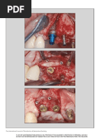 Straumann® Guided Surgery | PDF | Dental Implant | Surgery