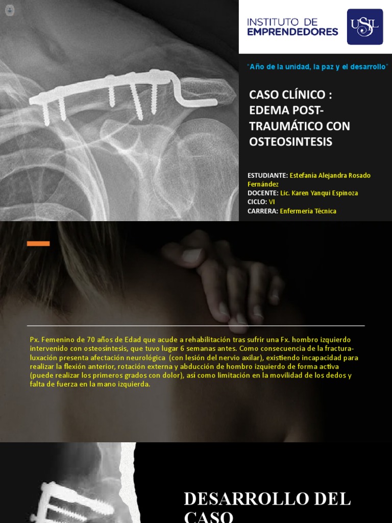Rehabilitación Edema Post-Traumático | PDF | Terapia física | Hombro