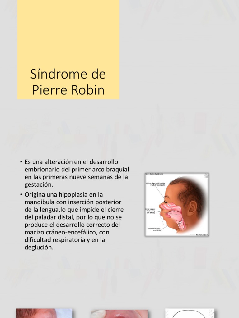 Síndrome Pierre Robin: Causas y Tratamiento | PDF | Odontología | Diente