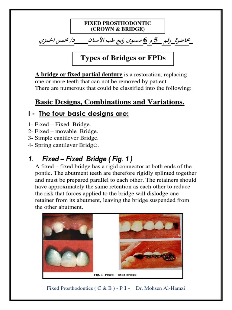 5 6 Types of Bridges or FPDS: 1. Fixed - Fixed Bridge (Fig. 1) | PDF ...