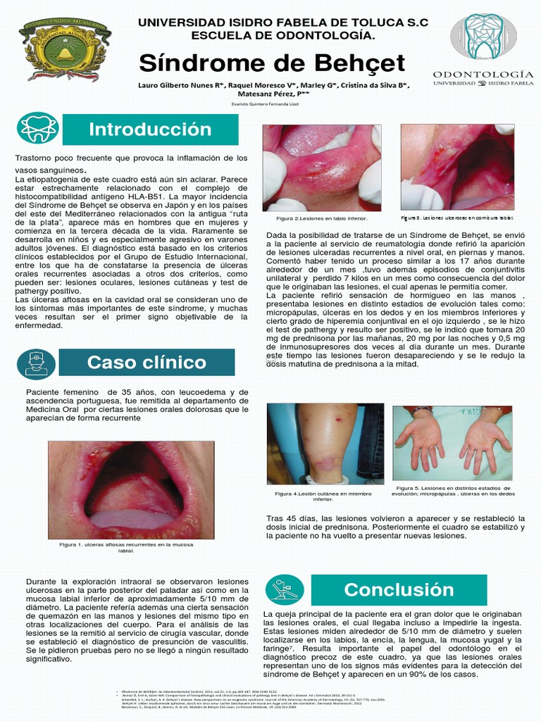 Síndrome de Behçet | PDF | Diagnostico medico | Epidemiología