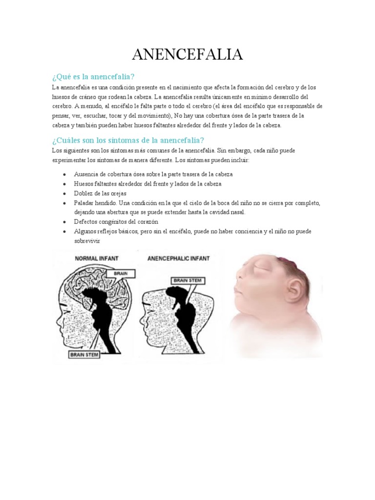 ANENCEFALIA | PDF