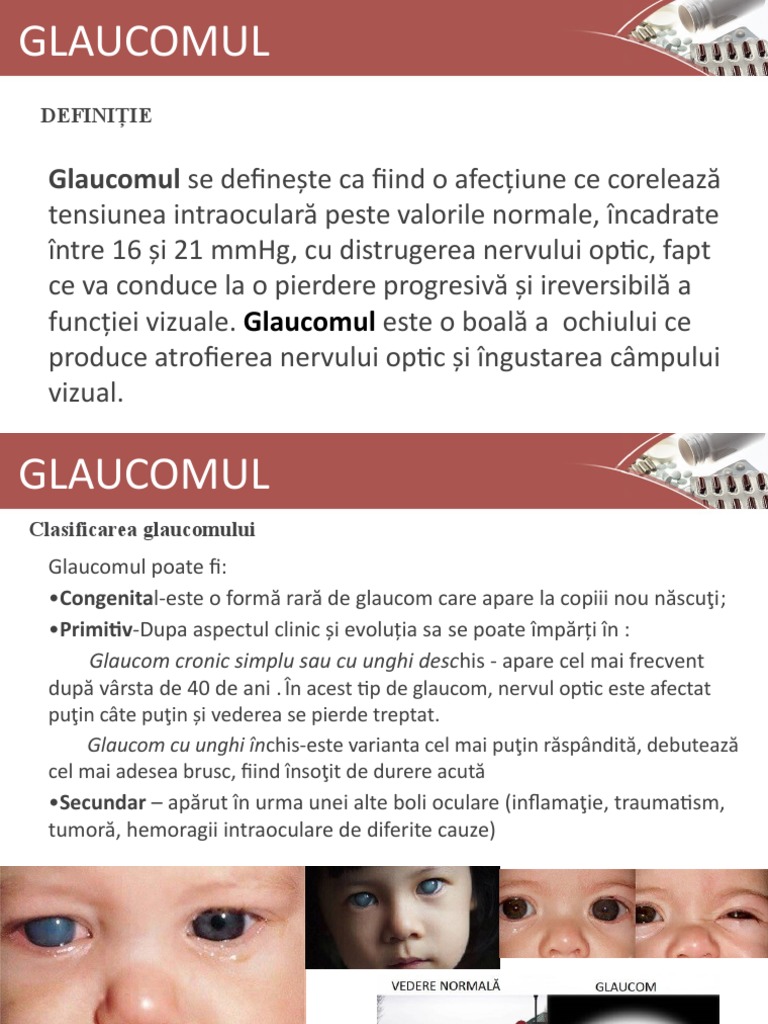 Glaucom Lucrare | PDF