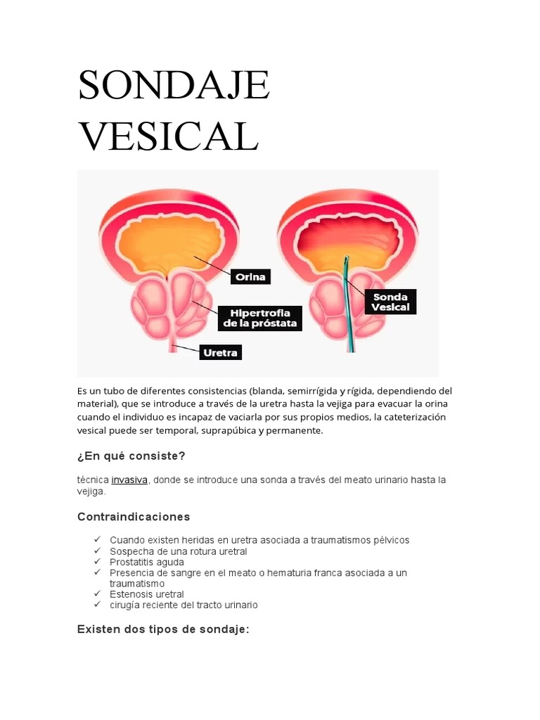 Sondaje Vesical | PDF | Vejiga urinaria | Sistema urinario