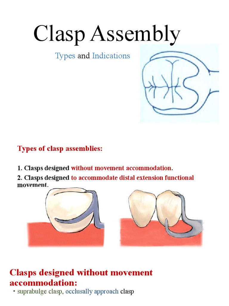 Types and Indications of Clasp Assemblies | PDF | Mouth | Dentistry ...
