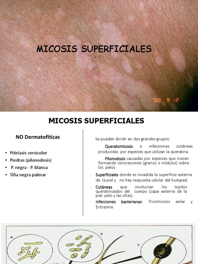 Clase 06 Micosis Superficiales | PDF | Piel