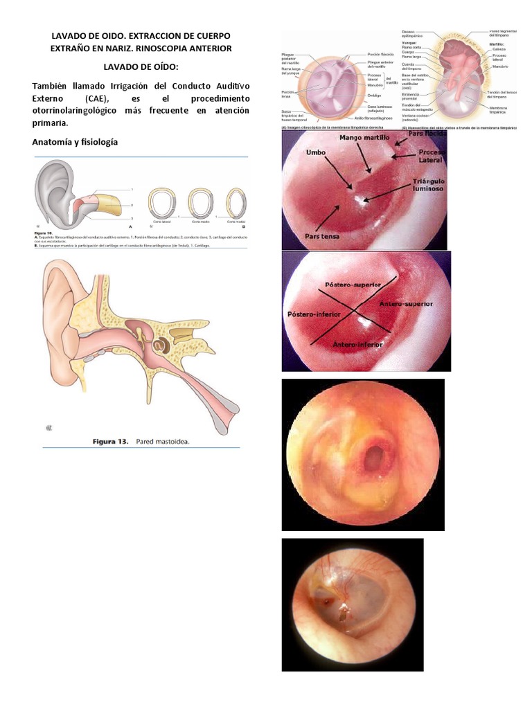 Lavado de Oído: Procedimiento y Cuidados | PDF | Oído | Enfermedades y trastornos