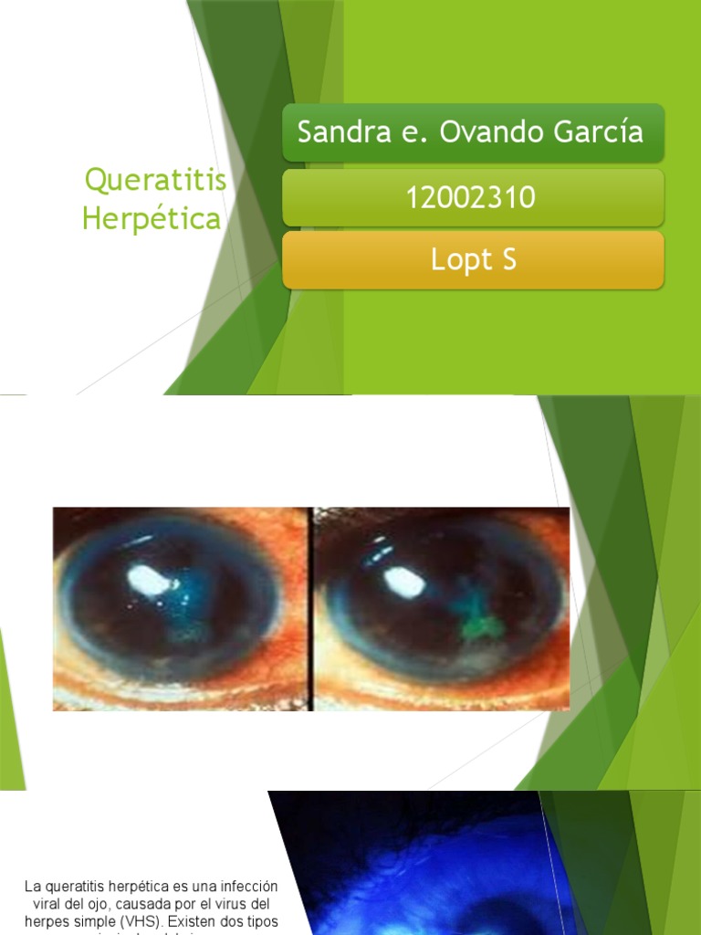 Presentación queratitis herpetica | PDF | Herpes Simple | Virus