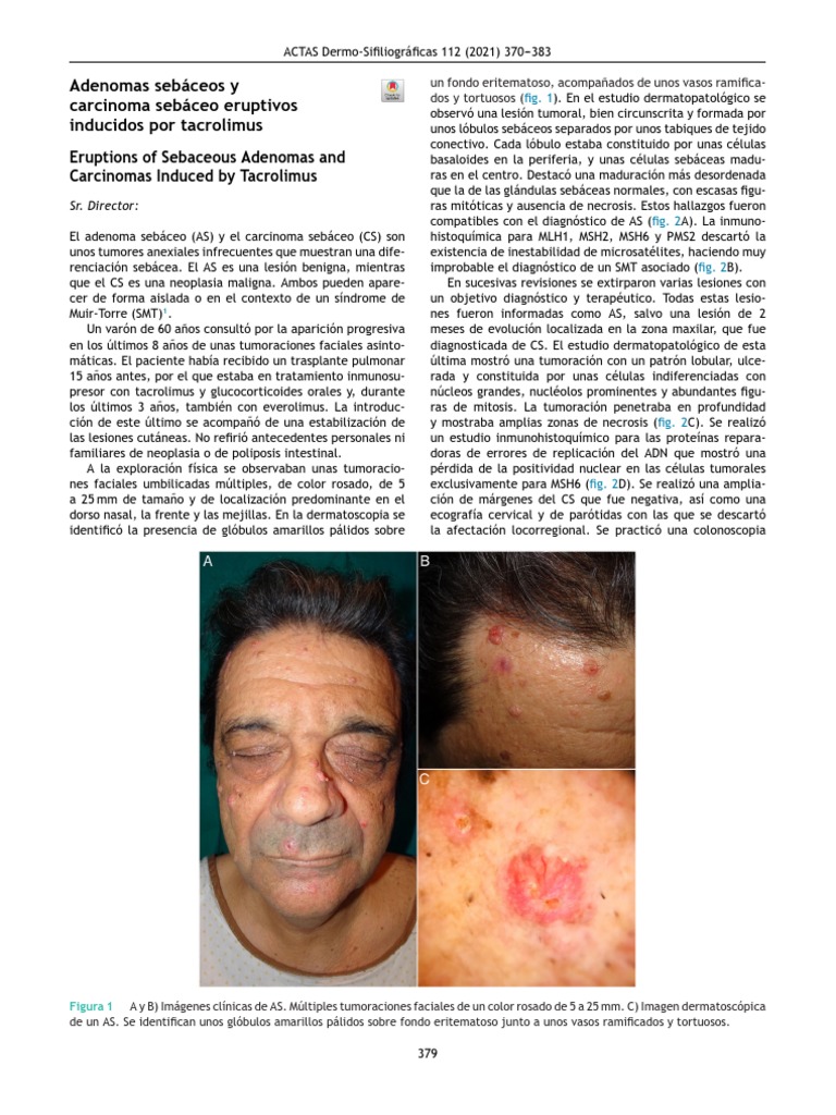 Adenoma Sebáceo | PDF | Cáncer | Especialidades Medicas