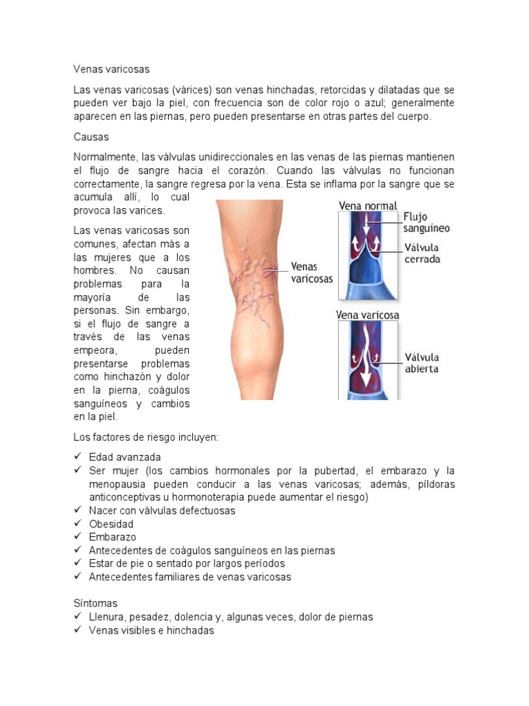 Venas Varicosas | PDF