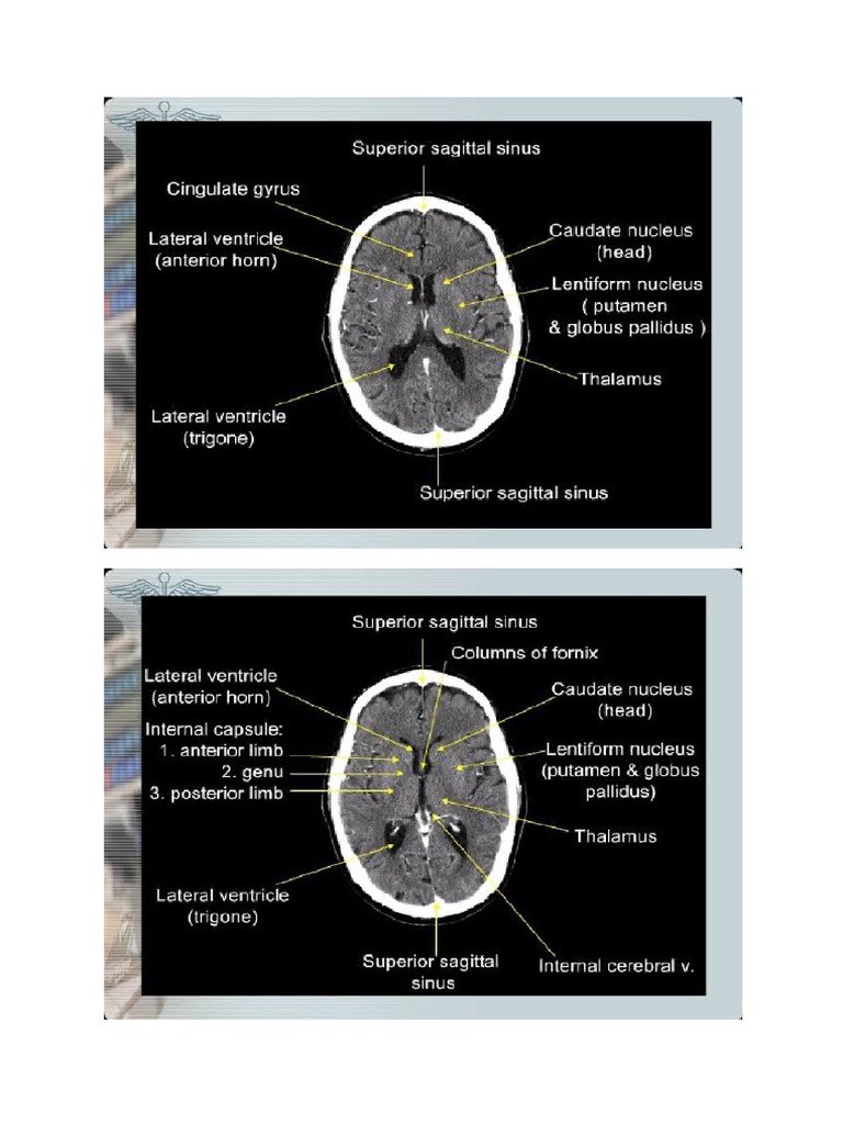 Anatomi CT Scan Kepala | PDF