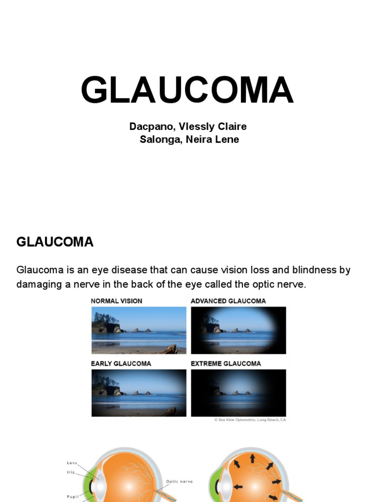 GLAUCOMA Revised Concept Map | PDF | Glaucoma | Human Eye