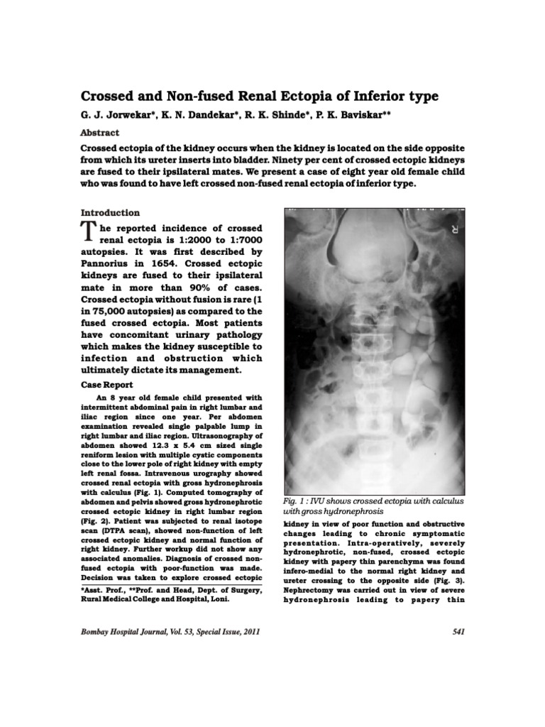 Crossed and Non-Fused Renal Ectopia of Inferior Type: G. J. Jorwekar, K ...