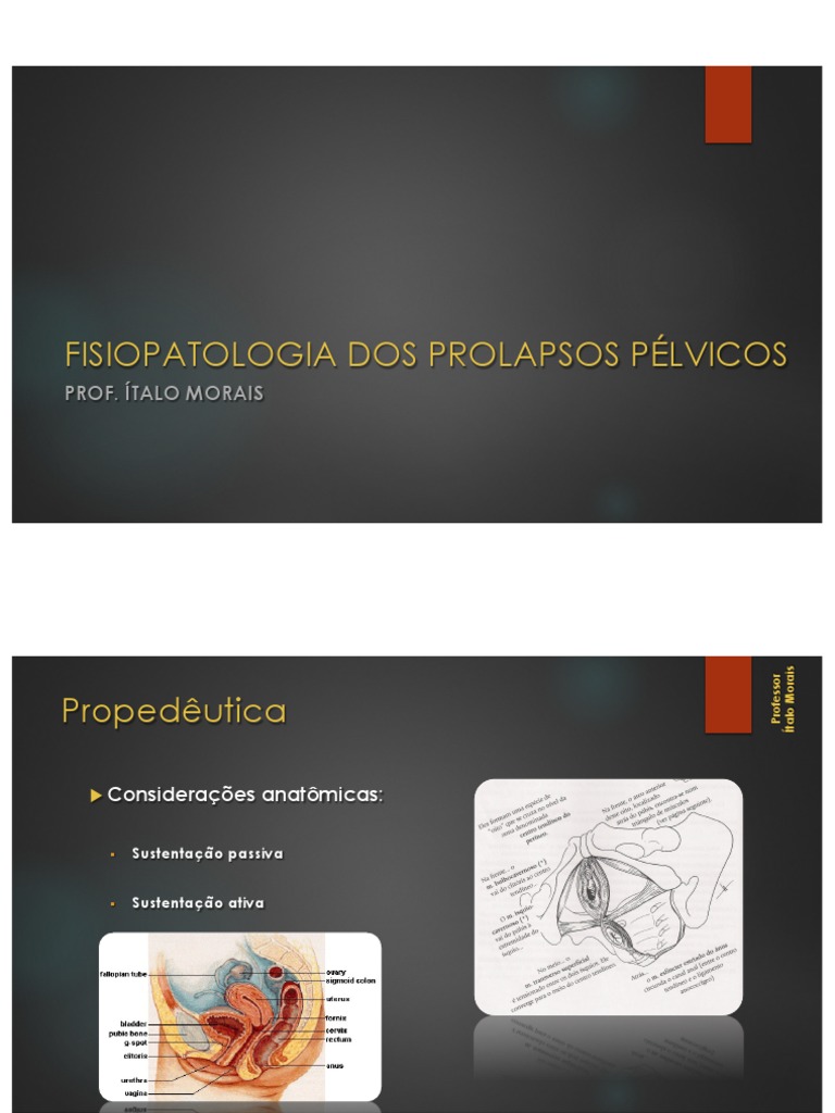 AULA 05 - Fisiopatologia Dos Prolapsos Pelvicos | PDF | Pélvis | Vagina