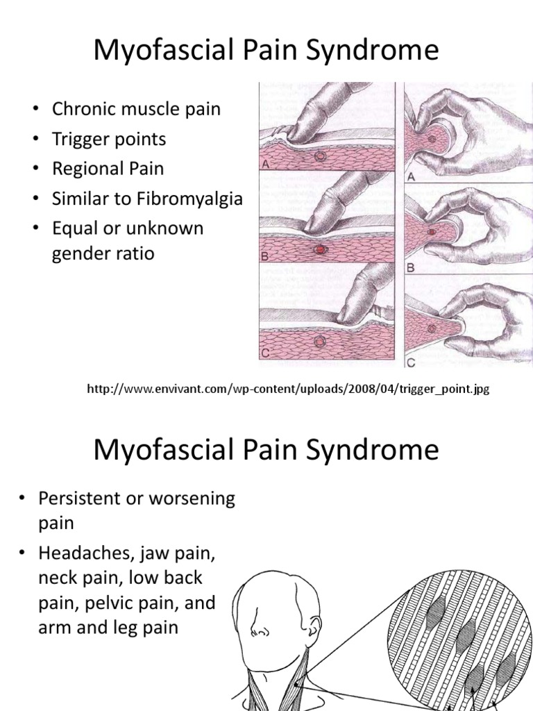 Myofascial Pain Syndrome Overview | PDF | Wellness | Science & Mathematics