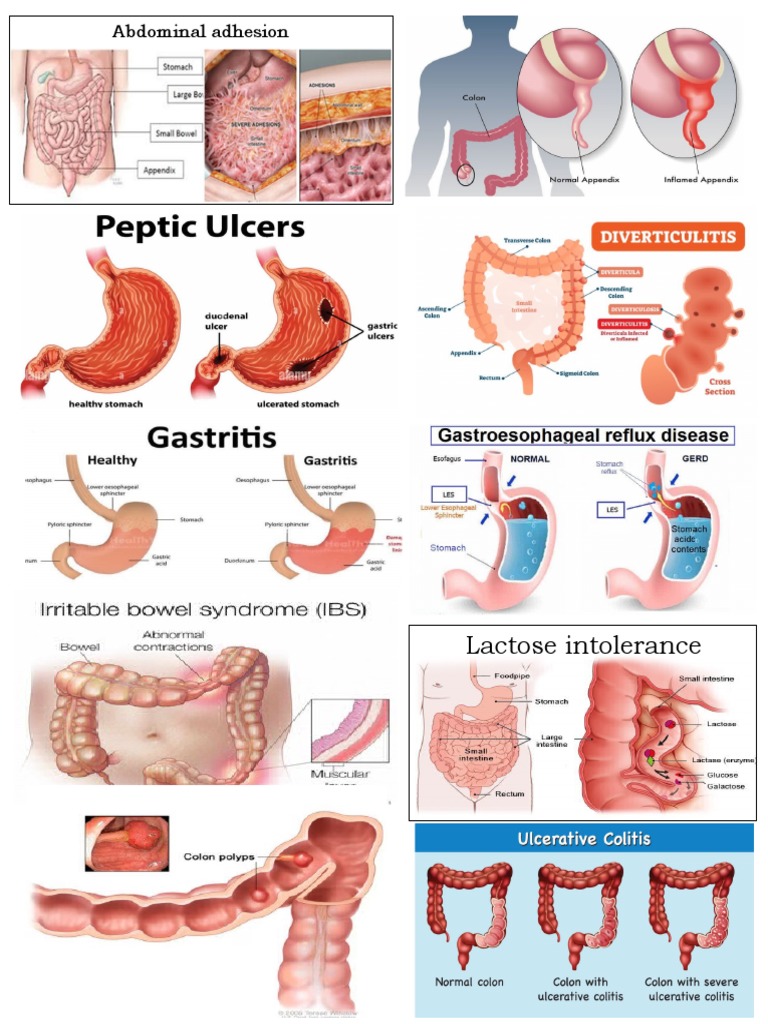 Diseases in Digestive System | PDF