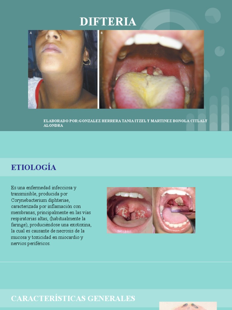 DIFTERIA | PDF | Resfriado comun | Epidemiología