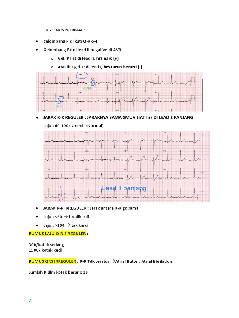 EKG SINUS | PDF