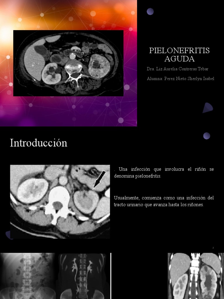 Pielonefritis Aguda | PDF