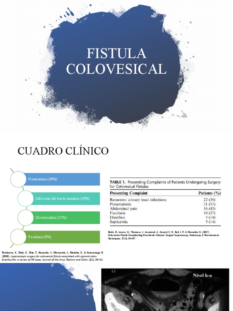 Fistula Colovesical | PDF | Especialidades Medicas | Medicina CLINICA