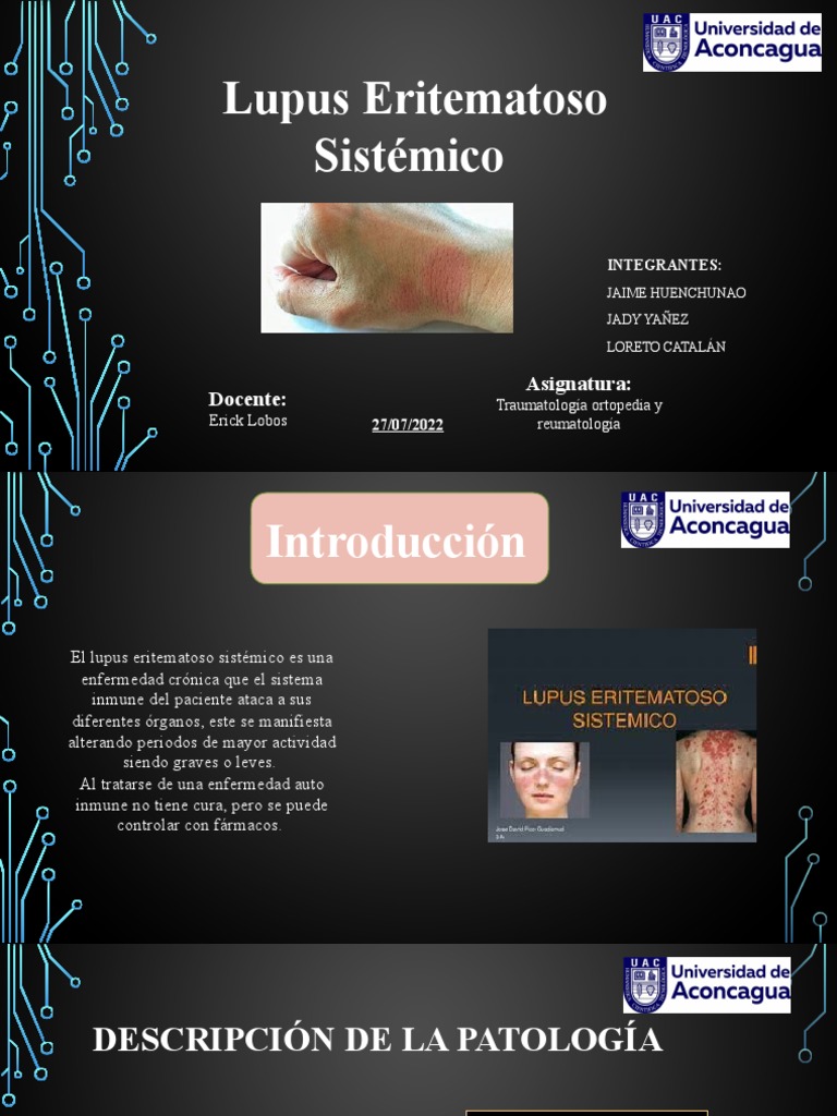 LUPUS ERITEMATOSO SISTEMICO PPT | PDF